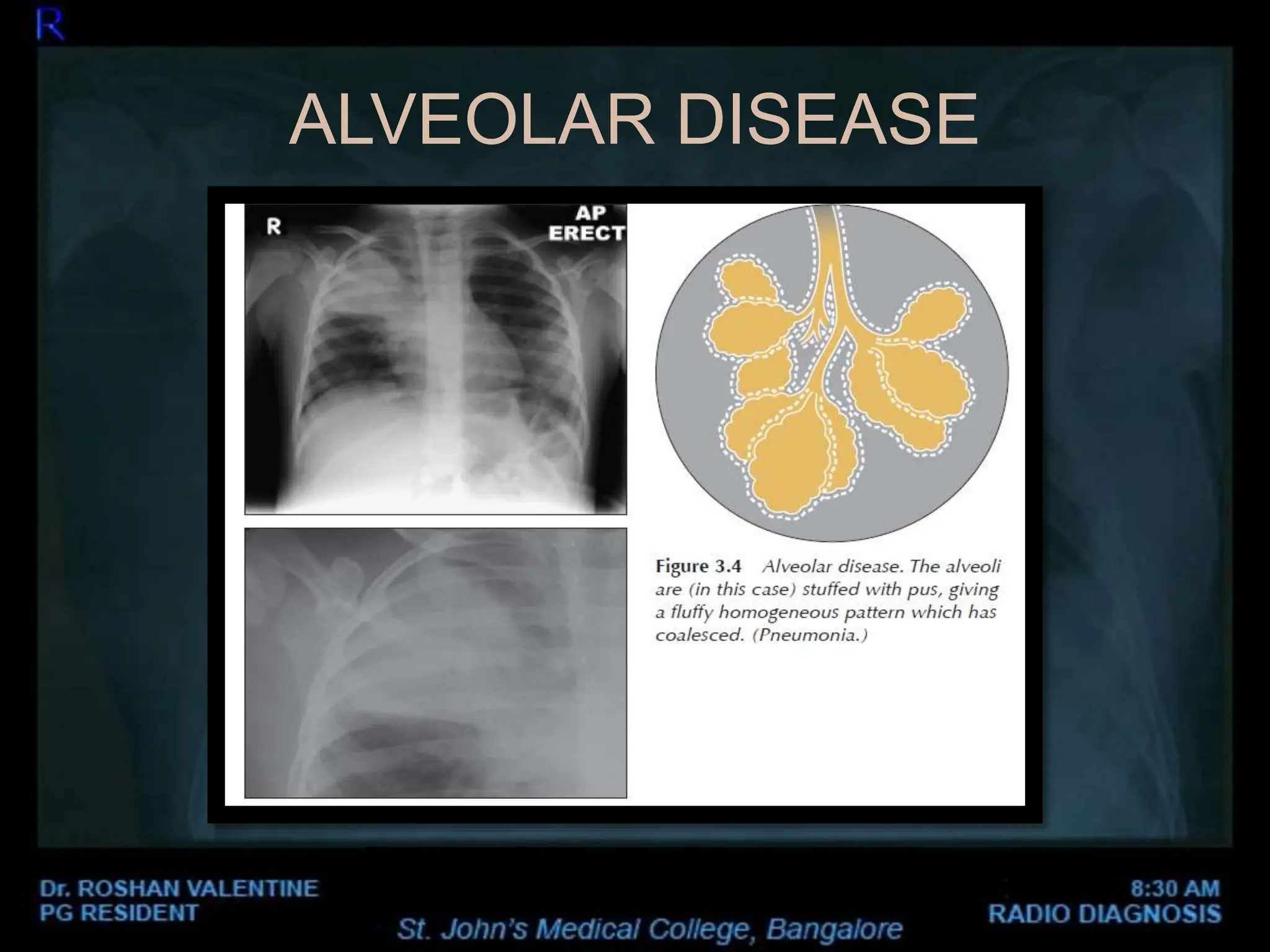 Abnormal chest xray with multiple chest views | PDF | Lung and ...