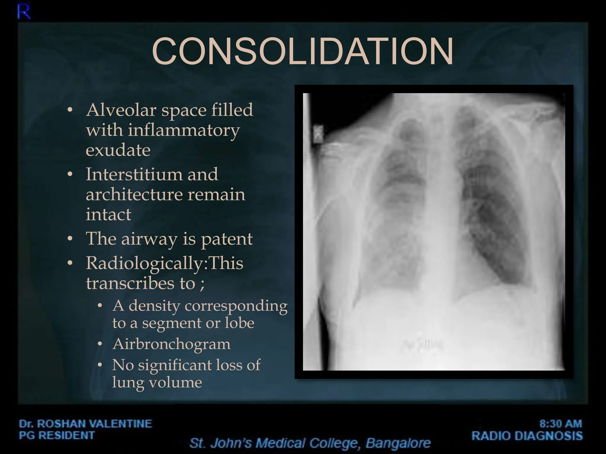 Abnormal chest xray with multiple chest views | PDF | Lung and ...