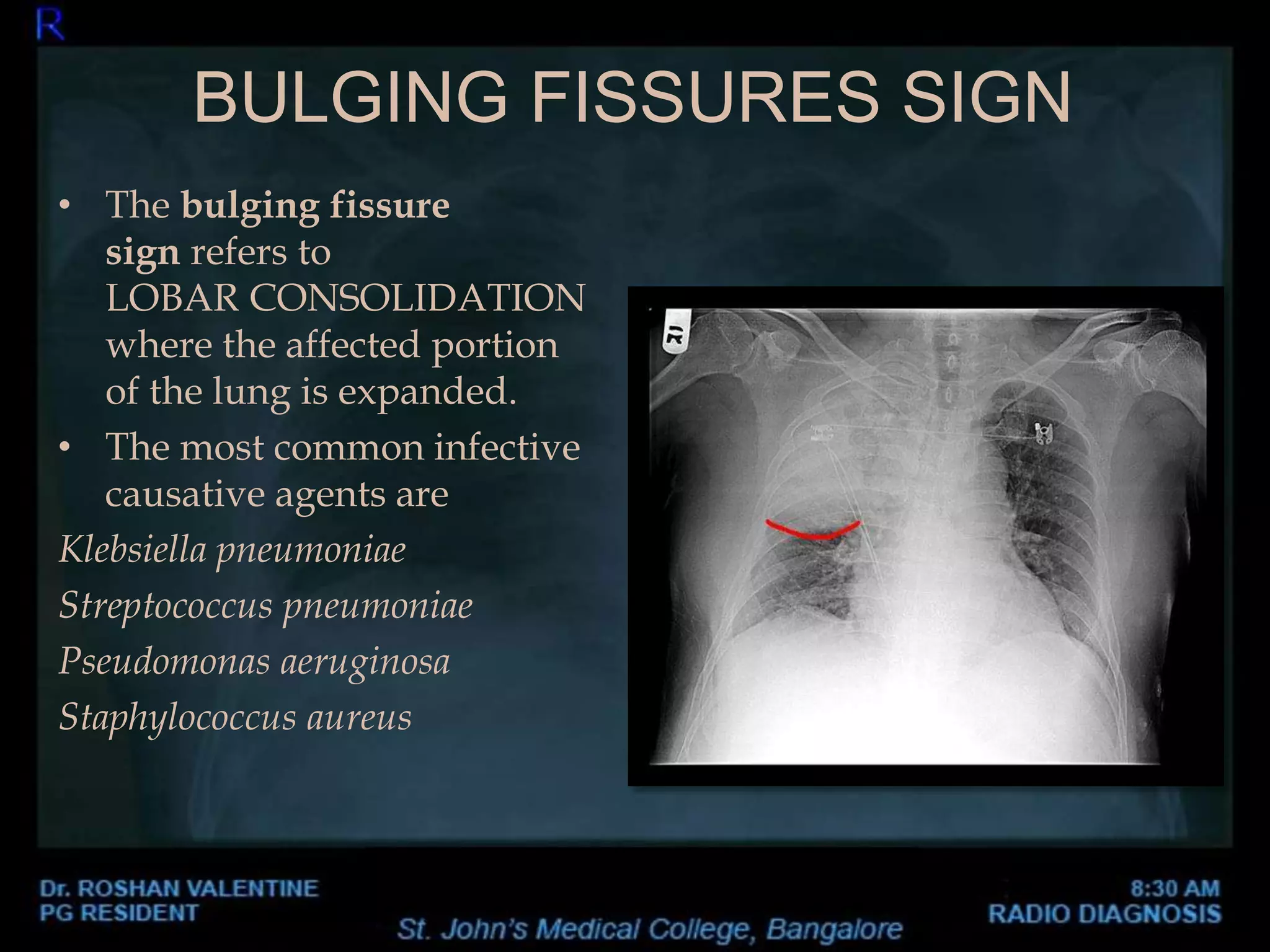 Abnormal Chest xray | PPTX