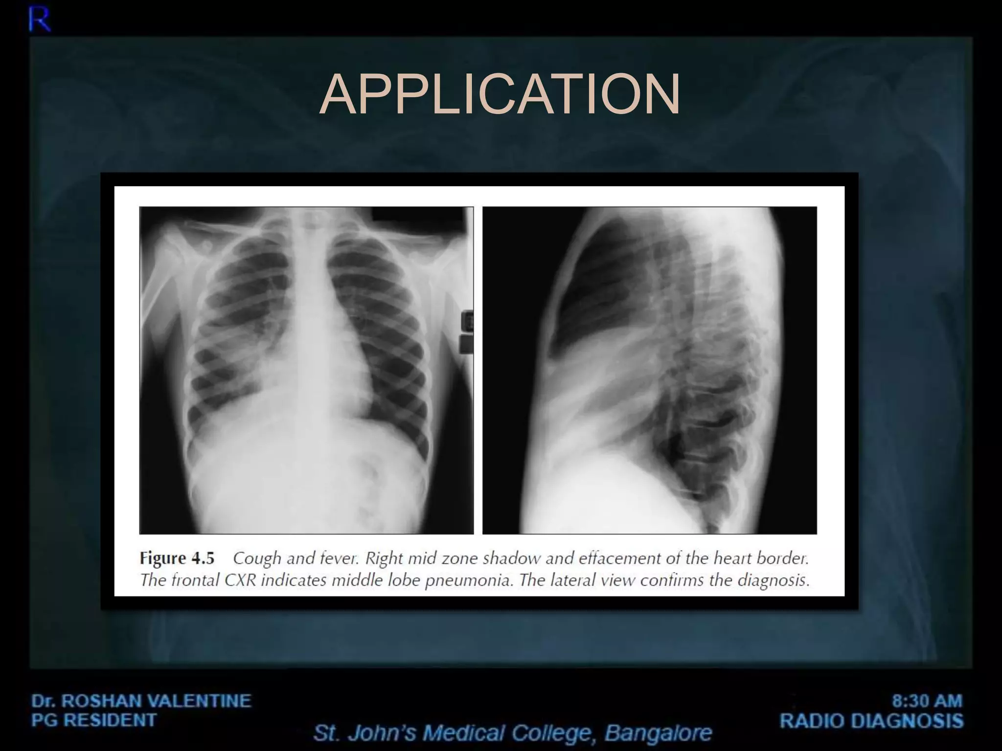 Abnormal Chest xray | PPTX