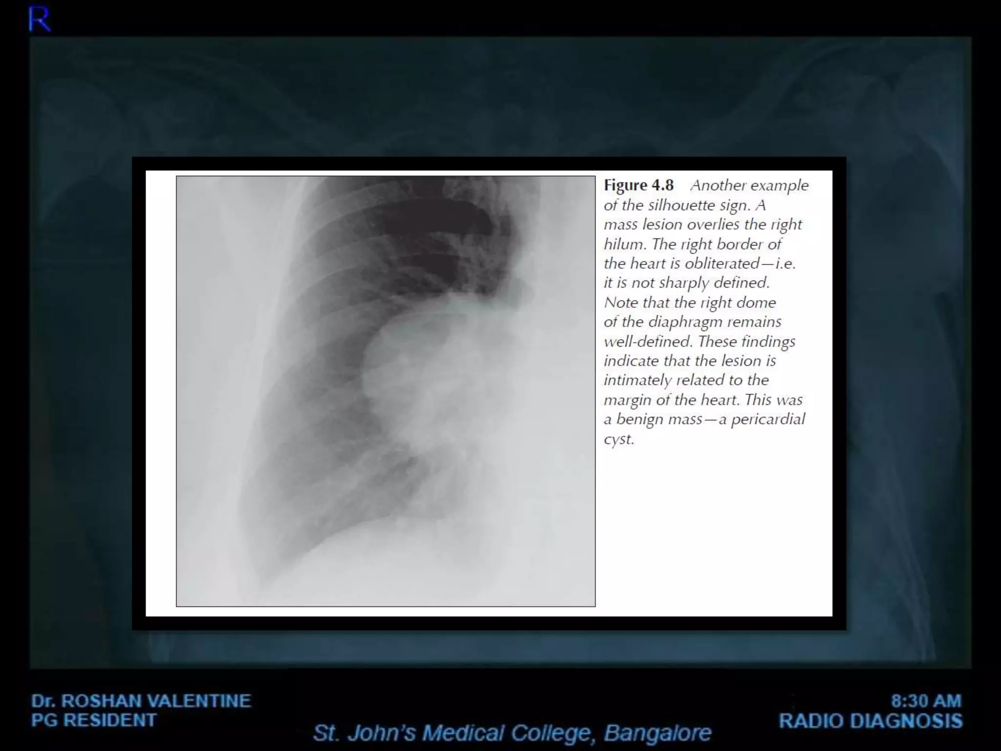 Abnormal Chest xray | PPTX