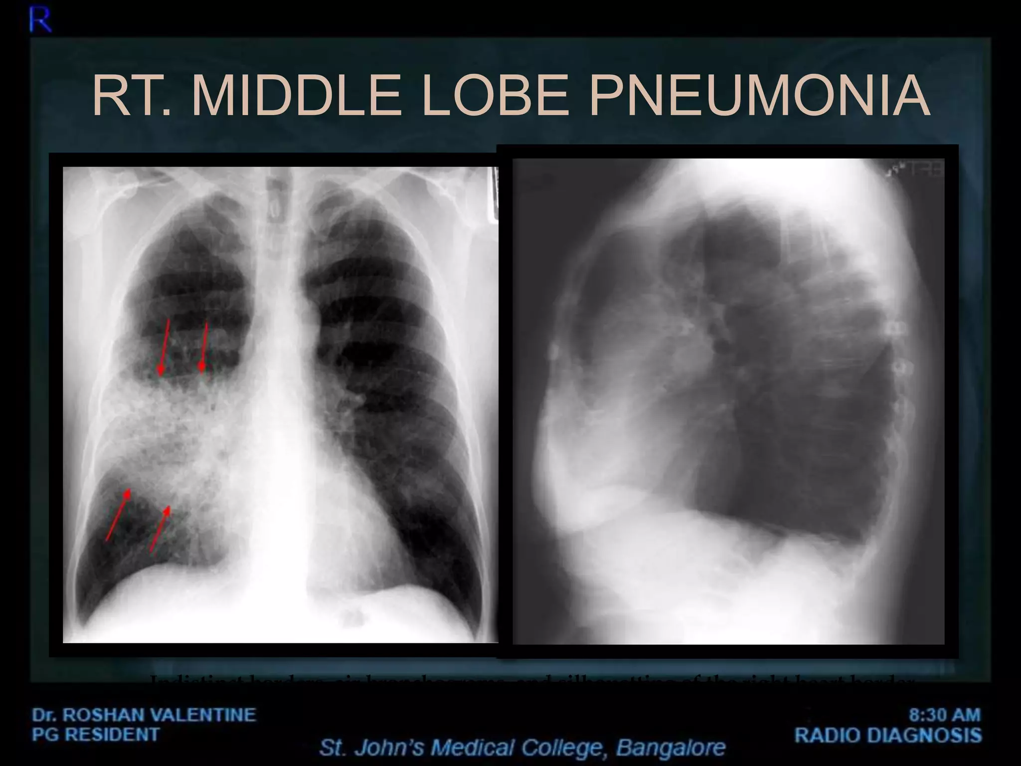 Abnormal Chest xray | PPTX