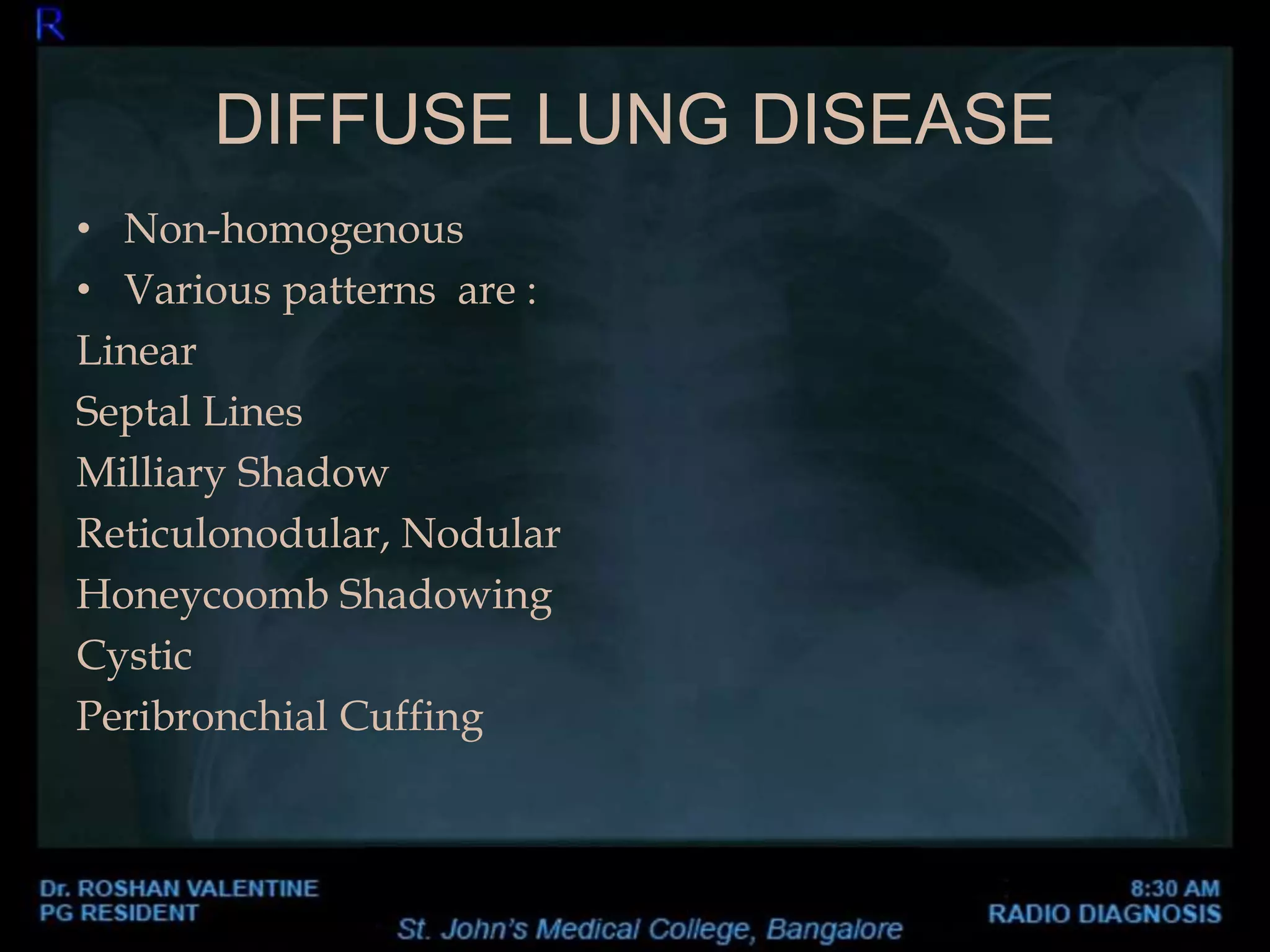 Abnormal Chest xray | PPTX