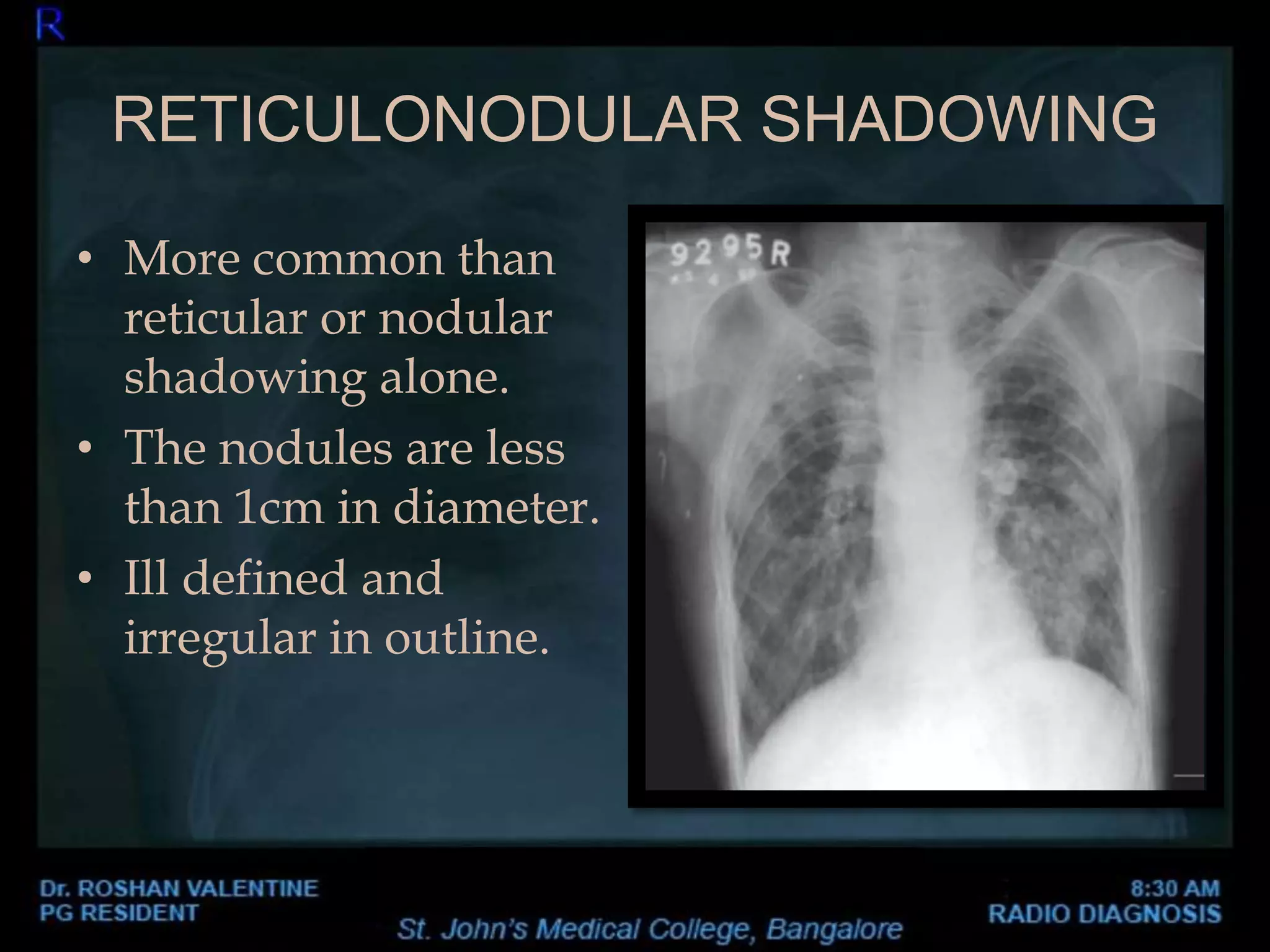 Abnormal Chest xray | PPTX