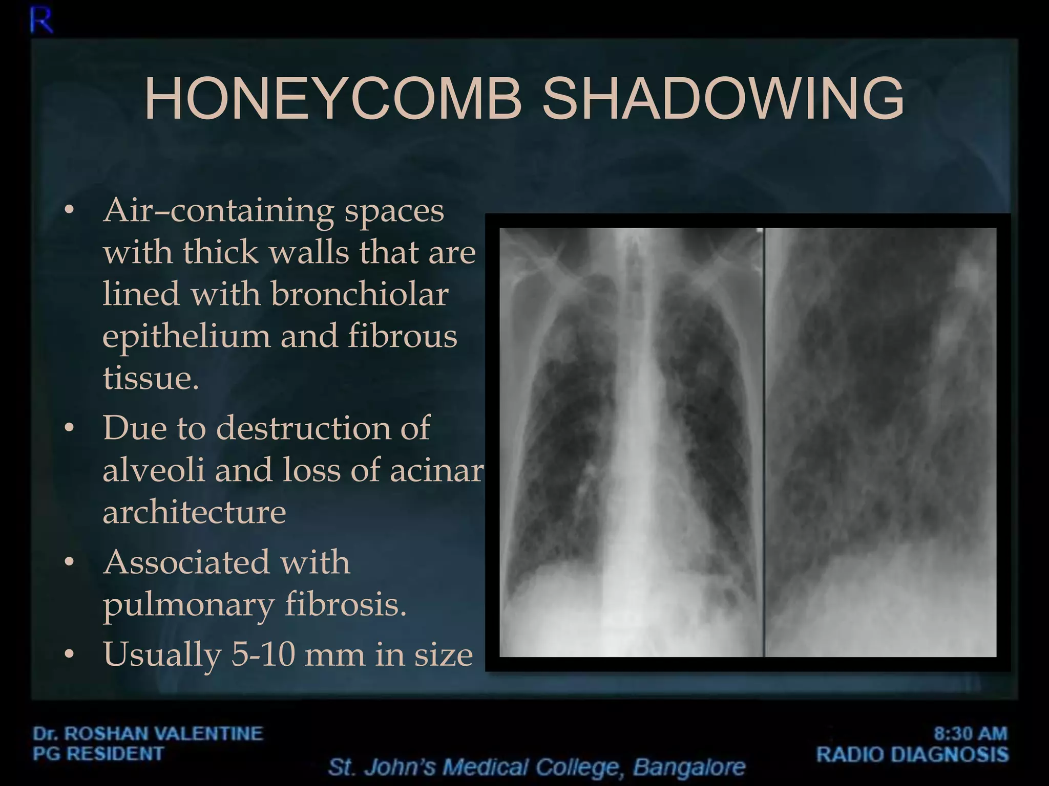 Abnormal Chest xray | PPTX