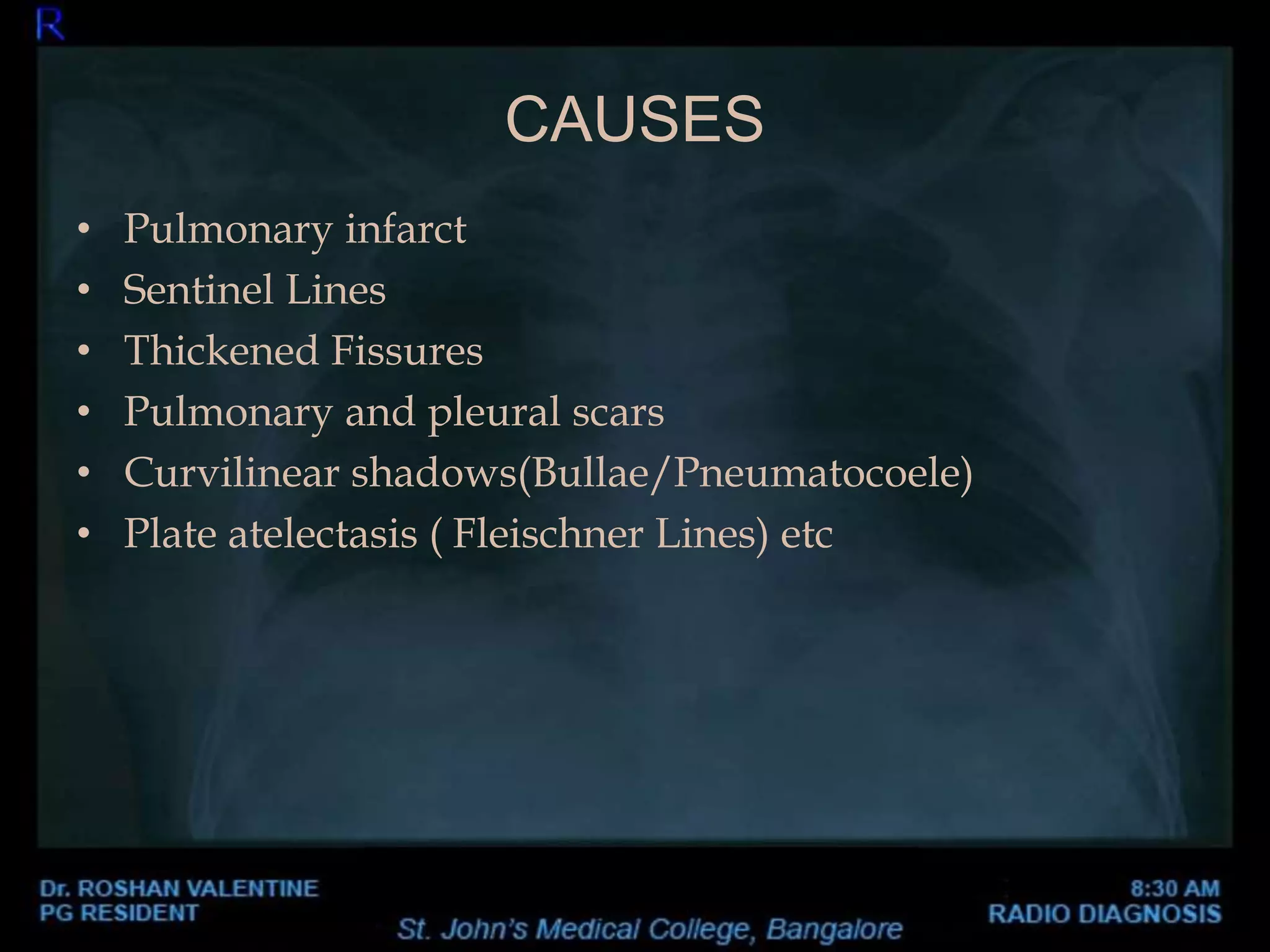 Abnormal Chest xray | PPTX