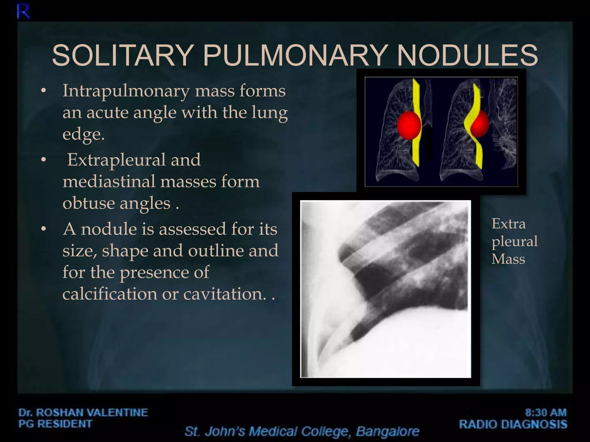 Abnormal Chest xray | PPTX