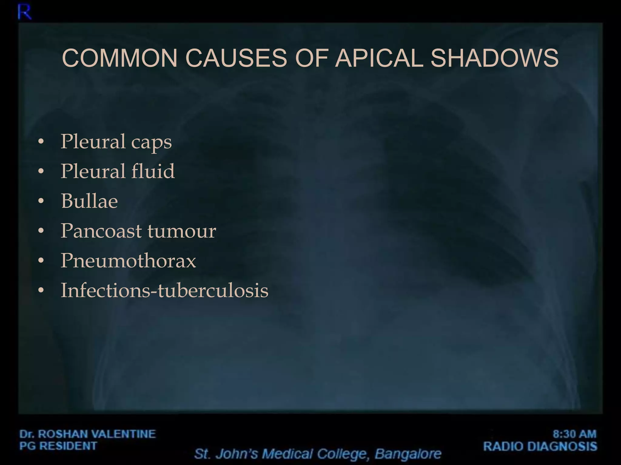 Abnormal Chest xray | PPTX