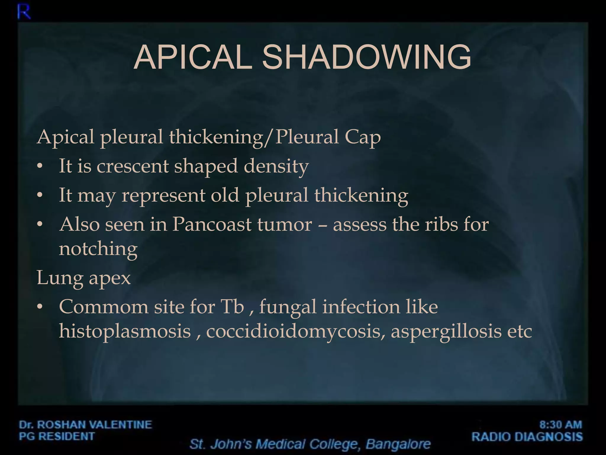 Abnormal Chest xray | PPTX