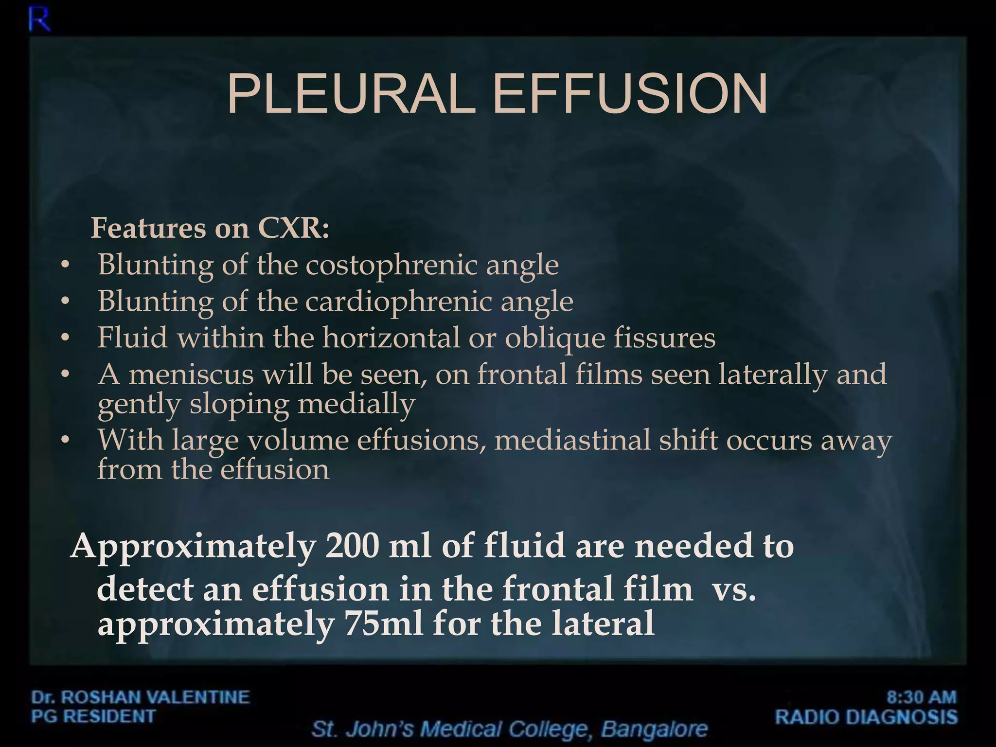 Abnormal Chest xray | PPTX
