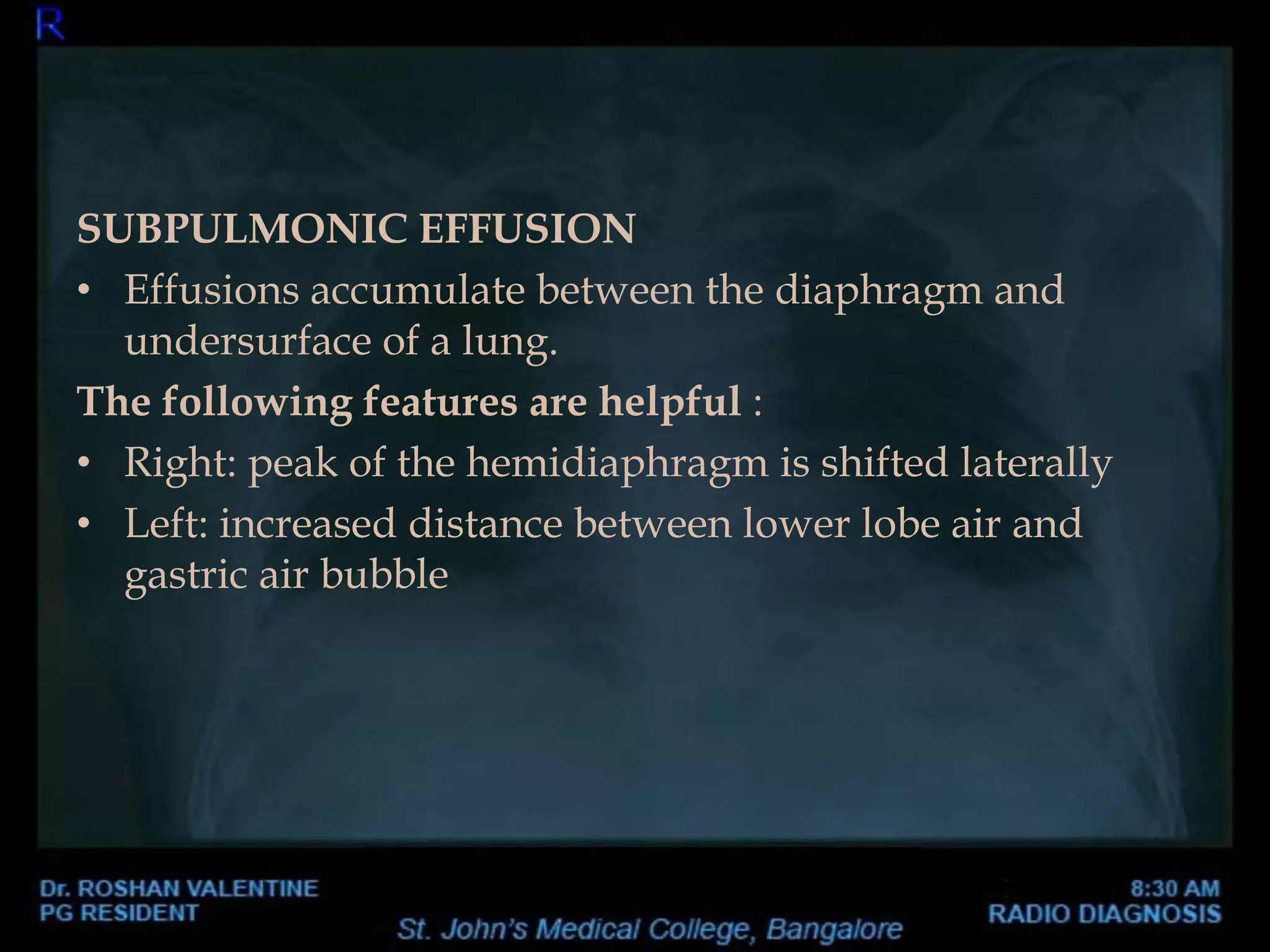 Abnormal Chest xray | PPTX