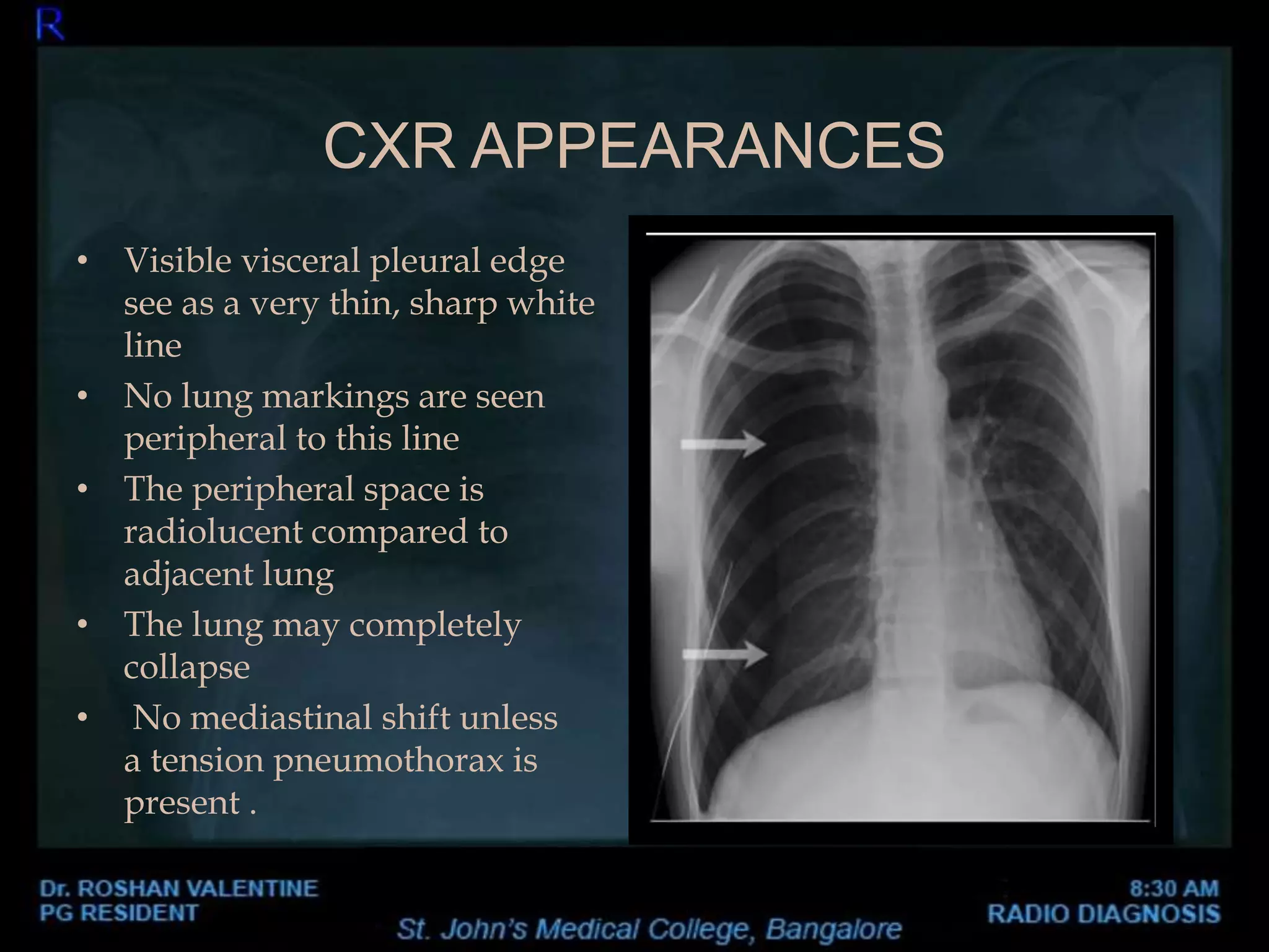 Abnormal Chest xray | PPTX