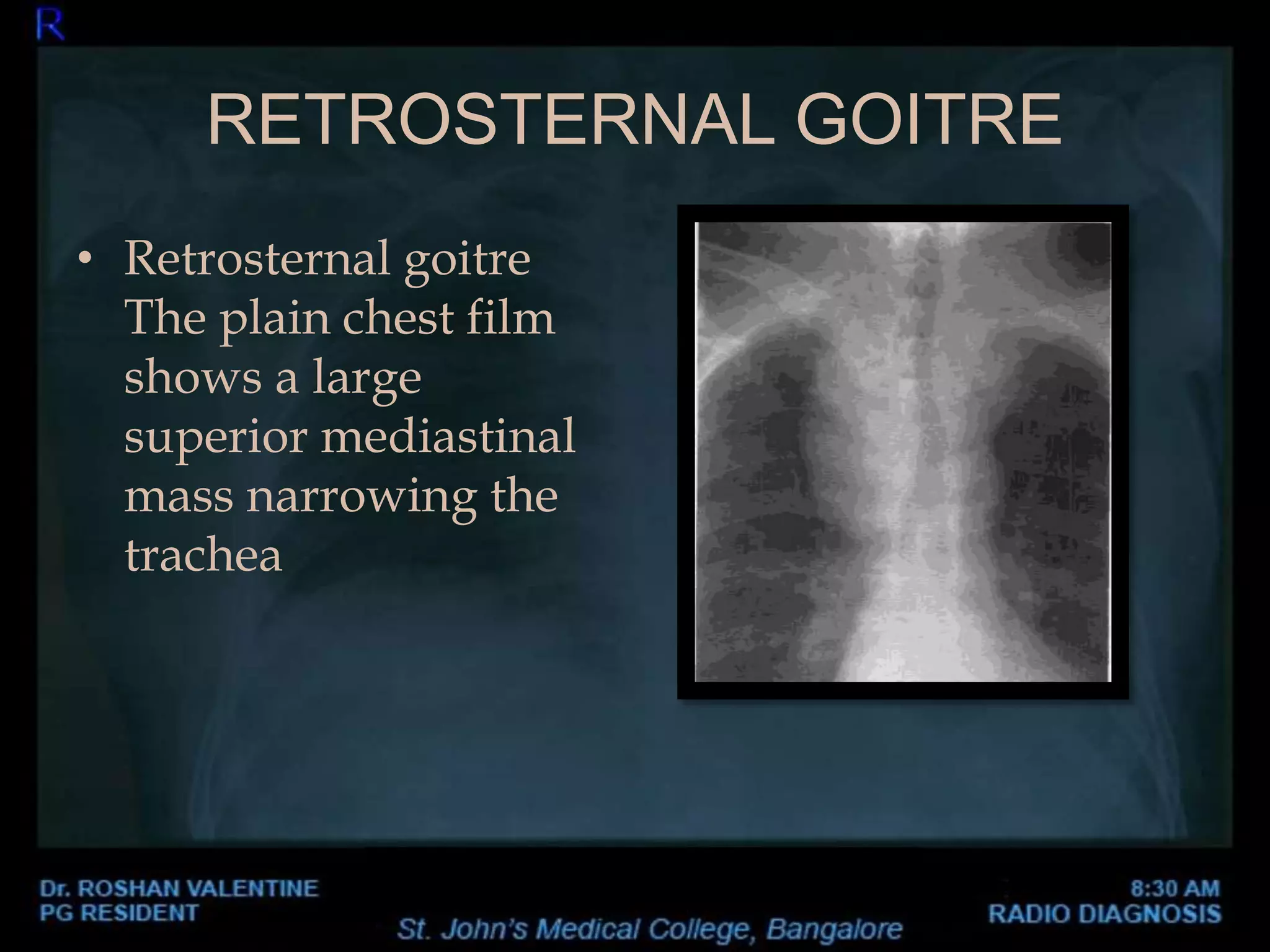 Abnormal Chest xray | PPTX