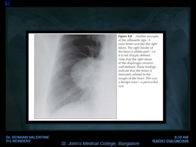 Abnormal Chest xray | PPTX
