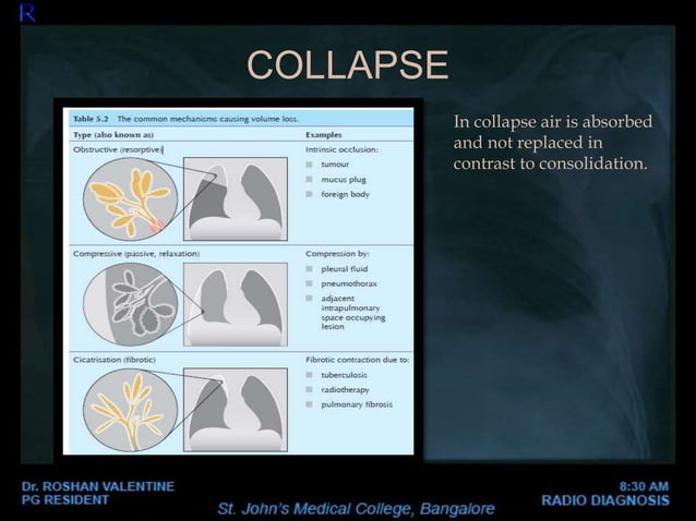 Abnormal Chest xray | PPTX