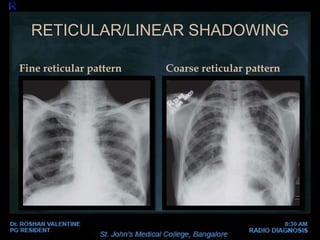 Abnormal Chest xray | PPTX