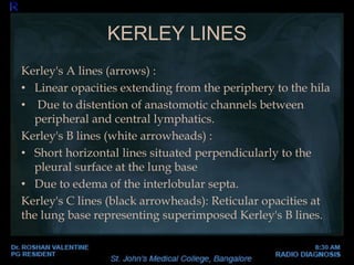 Abnormal Chest xray | PPTX