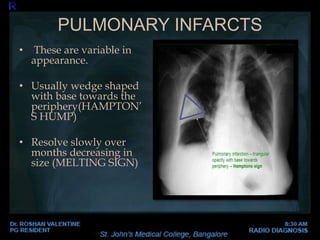 Abnormal Chest xray | PPTX