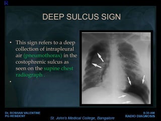 Abnormal Chest xray | PPTX