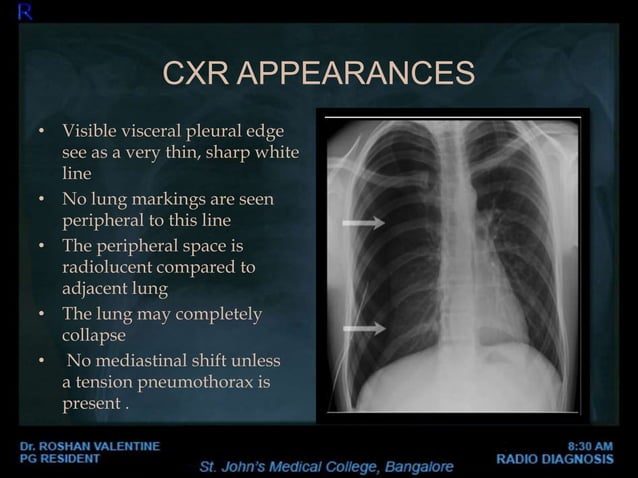 Abnormal Chest xray
