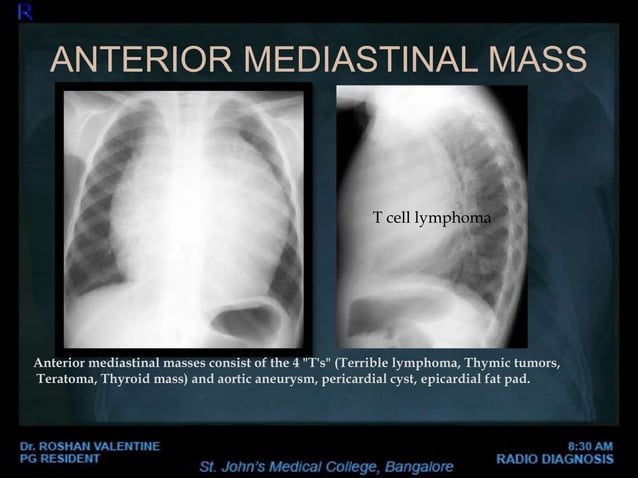 Abnormal Chest xray