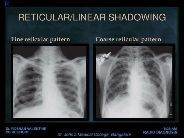 Abnormal Chest xray