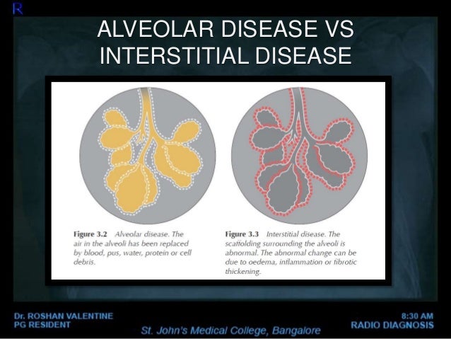 Abnormal Chest xray
