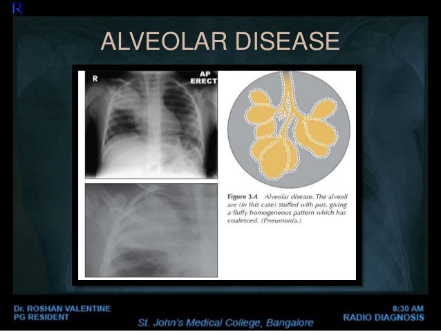 Alveolar dead space causes - qosamaven