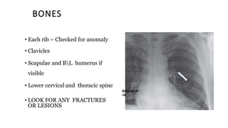 Chest xray | PPTX