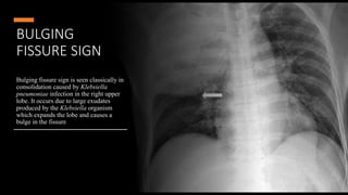 Chest xray | PPTX
