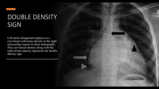 Chest xray | PPTX