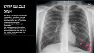 Chest xray | PPTX