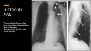 Chest xray | PPTX
