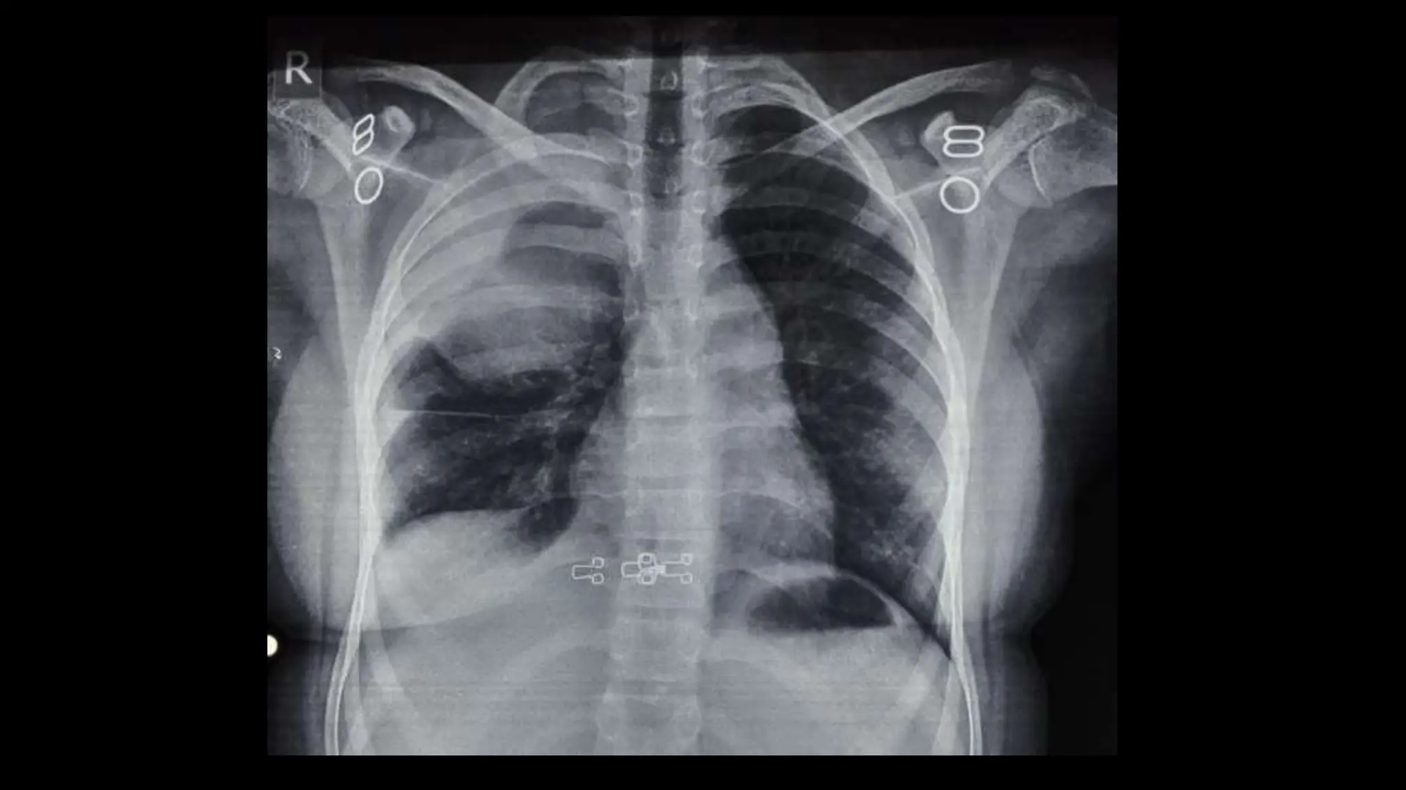 CHEST XRAY interpretation cases radiology.pptx