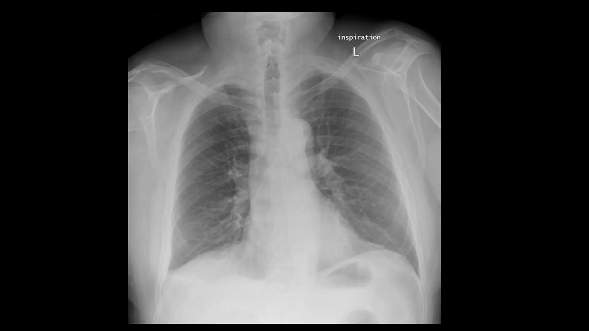 CHEST XRAY interpretation cases radiology.pptx