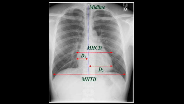 CHEST XRAY interpretation cases radiology.pptx