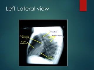 READING CHEST X RAY : MAKING DIAGNOSIS EASIER | PPT
