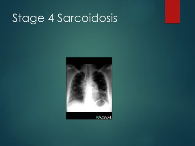 READING CHEST X RAY : MAKING DIAGNOSIS EASIER | PPT