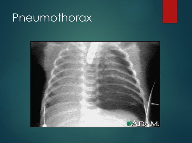 READING CHEST X RAY : MAKING DIAGNOSIS EASIER | PPT