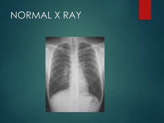 READING CHEST X RAY : MAKING DIAGNOSIS EASIER | PPT