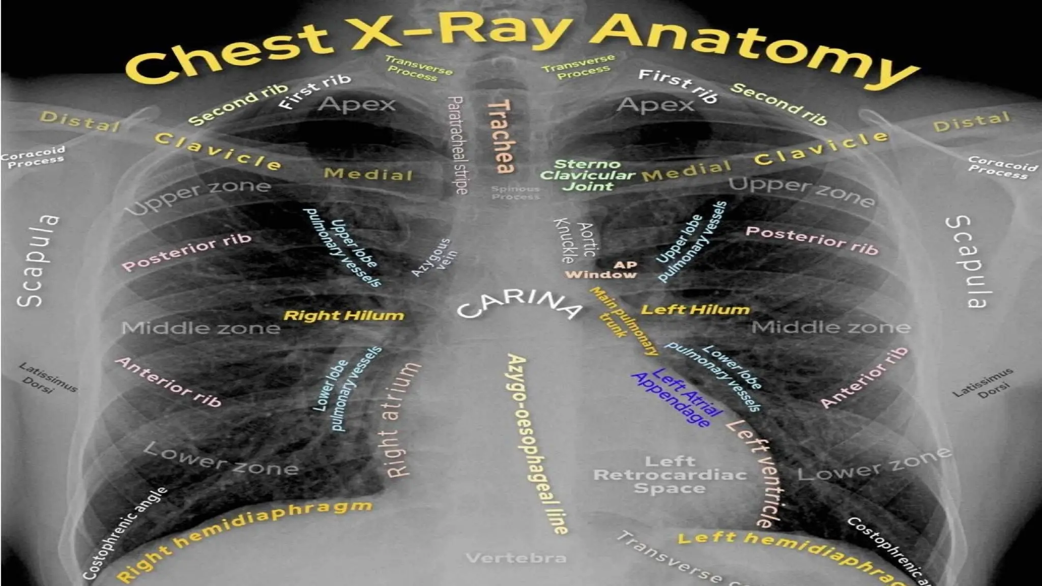 CHEST XRAY normal anatomy and pathology.pptx