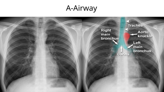 CHEST XRAY normal anatomy and pathology.pptx