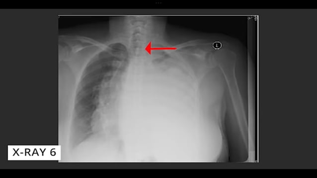 CHEST XRAY normal anatomy and pathology.pptx