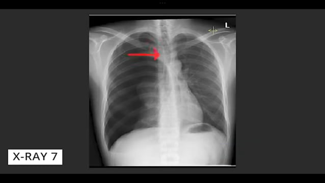 CHEST XRAY normal anatomy and pathology.pptx