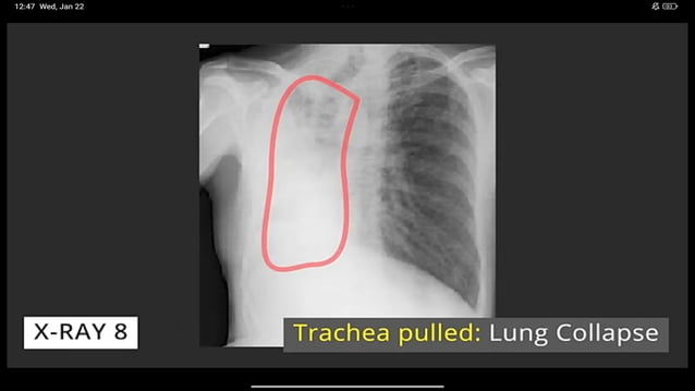 CHEST XRAY normal anatomy and pathology.pptx