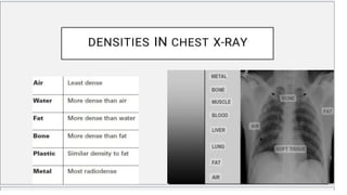 CHEST XRAY normal anatomy and pathology.pptx