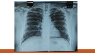 Chest X-Ray Views & Key Radiologic Signs | PPTX