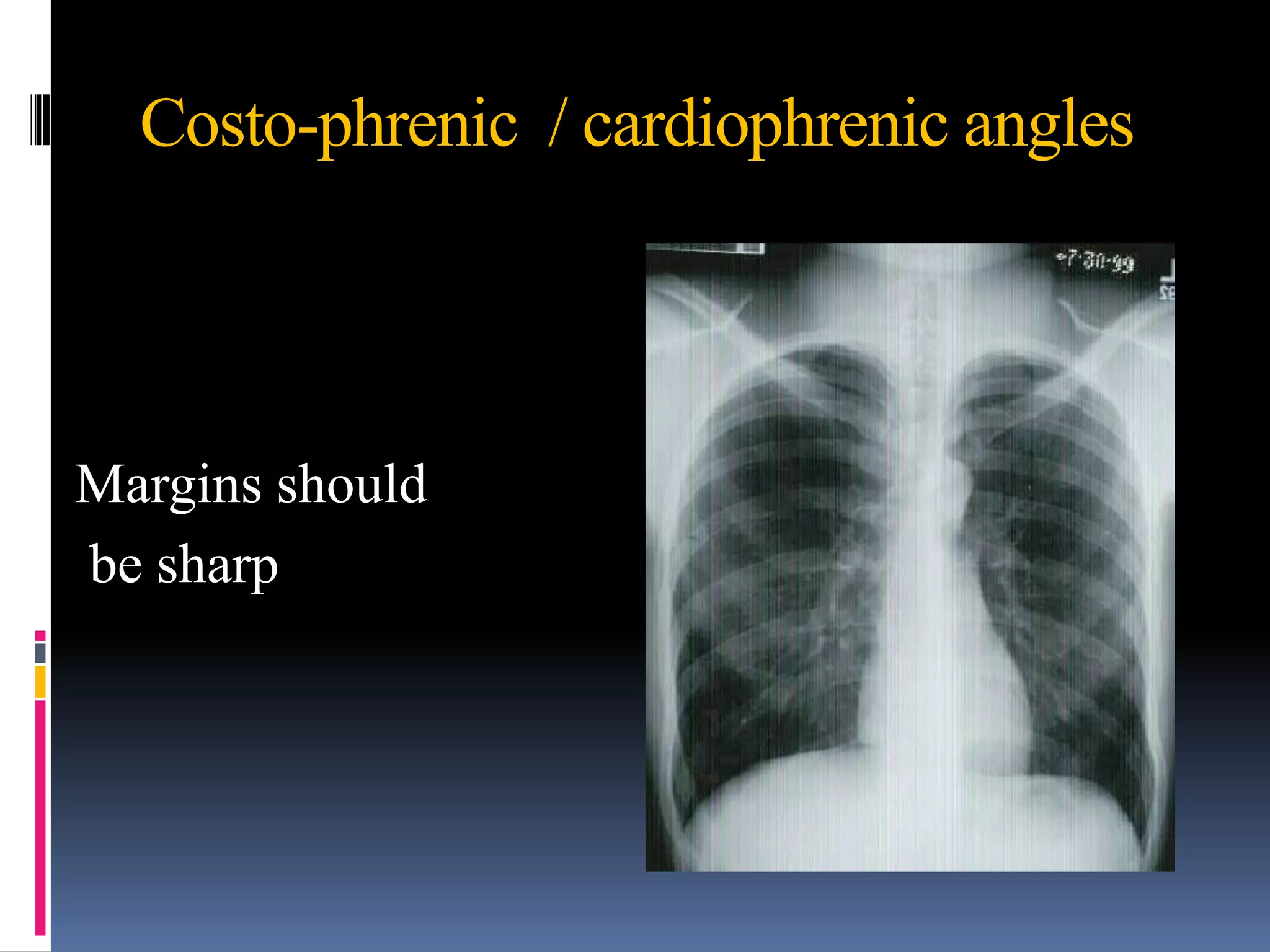 Chest xray | PPTX