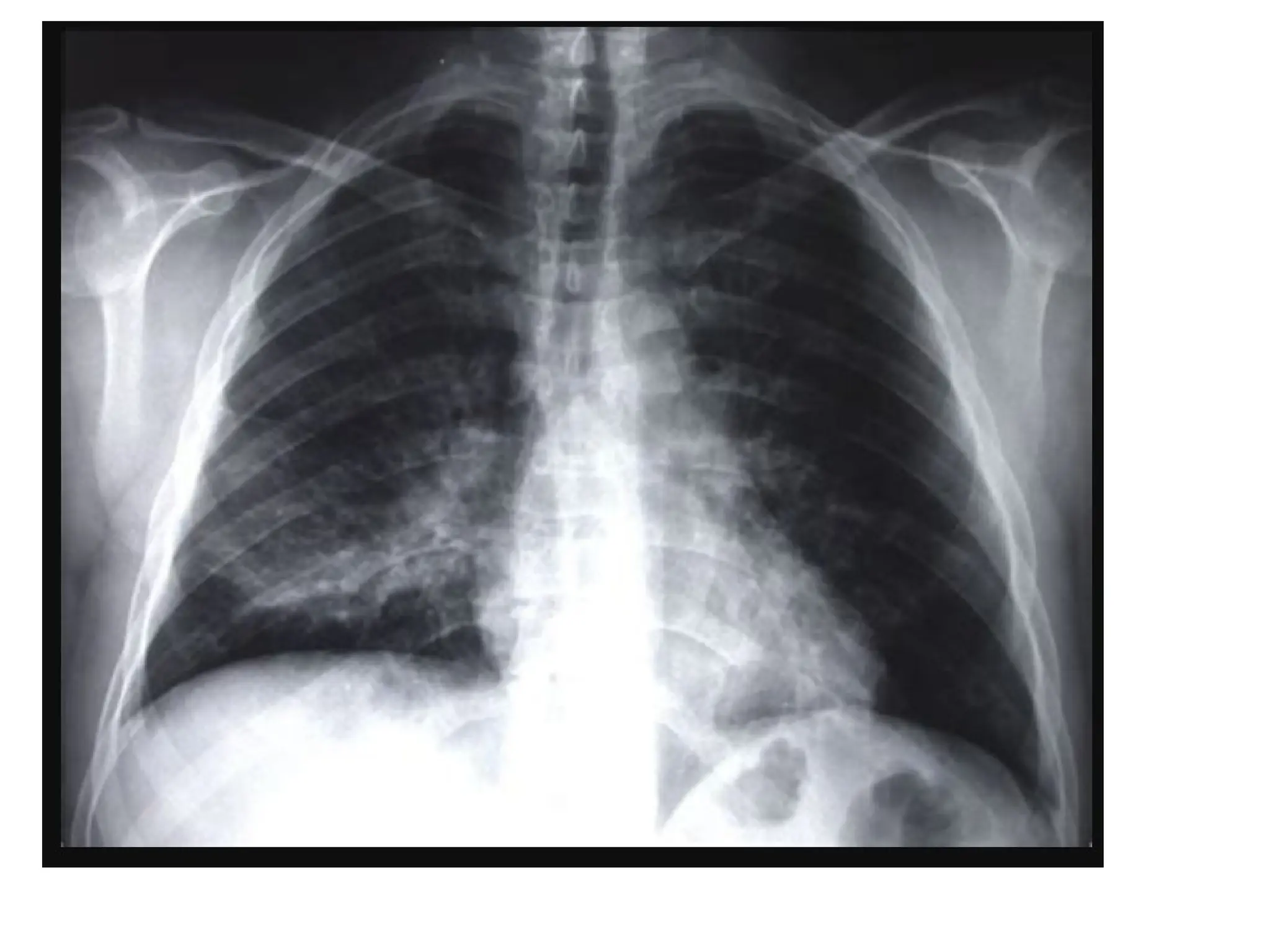 Chest X ray ap and pa view , findings in various diseases | PPTX