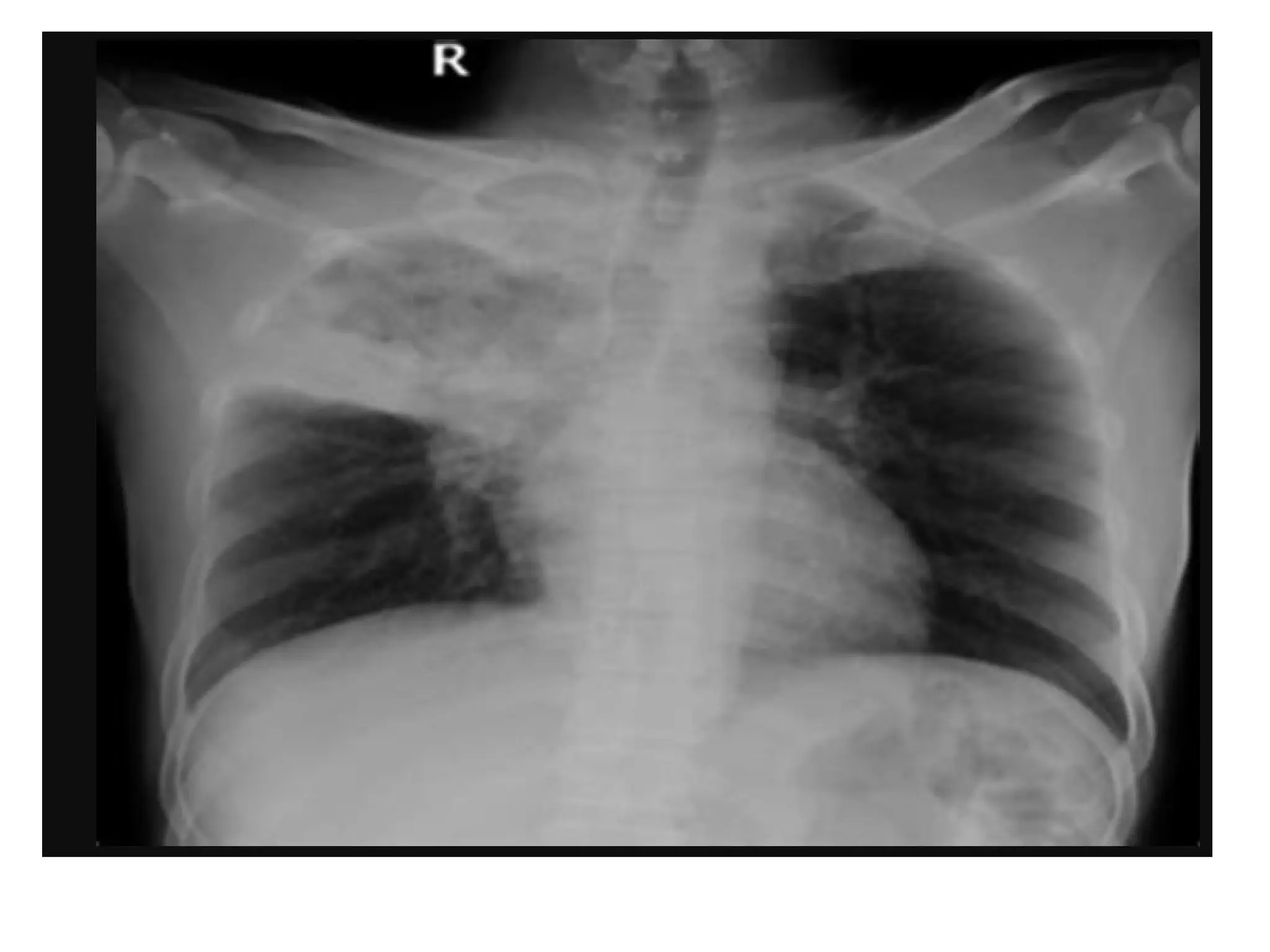 Chest X ray ap and pa view , findings in various diseases | PPTX